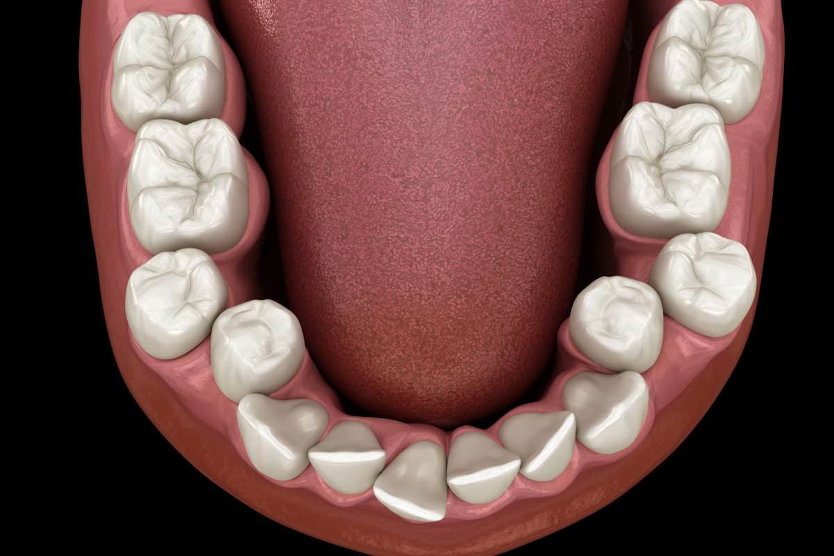 Crossbite – Orthrodontic