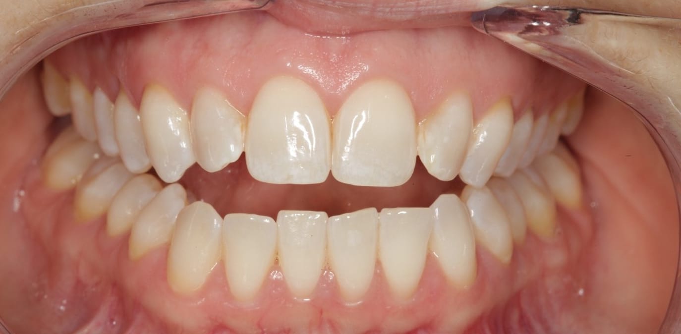 Open Bite - Best Orthodontic Dentists