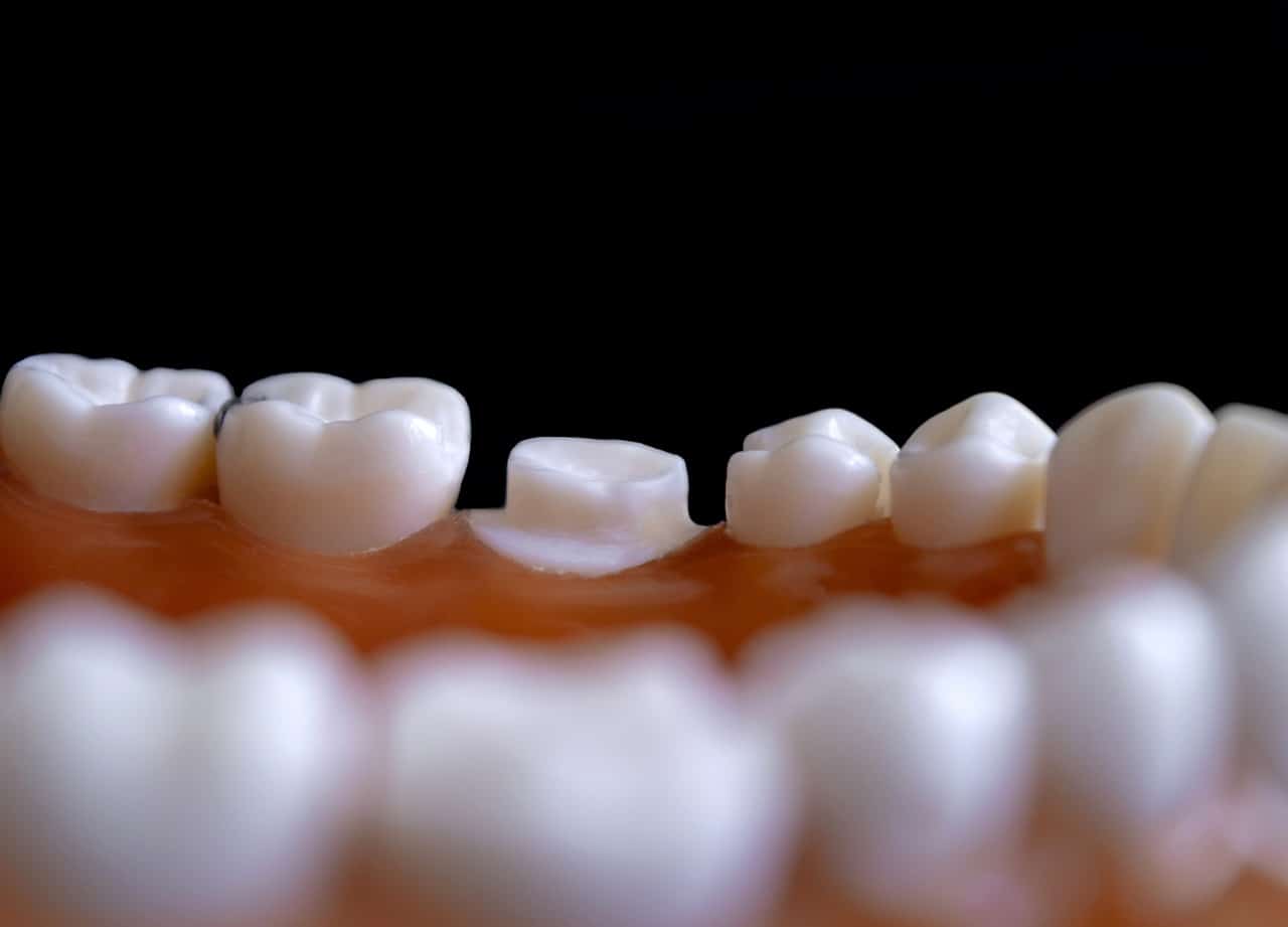 Retainers And Long-Term Results Of Orthodontic Treatment - Best ...